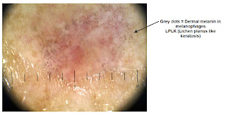 Dermoscopy Made Simple: Great Blog Cases
