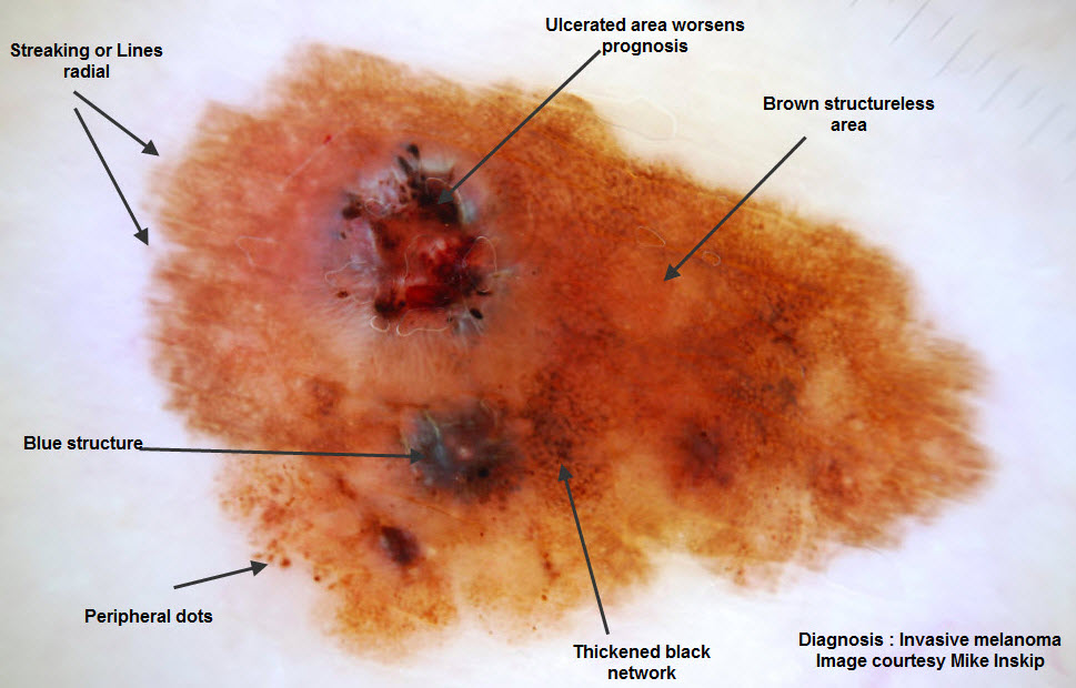 Melanoma Dermoscopy at Sandra Herring blog