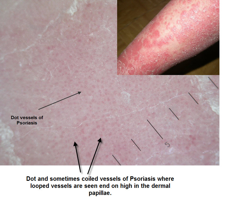 Dermoscopy Made Simple: Vessels