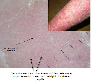 Dermoscopy Made Simple: Vessels