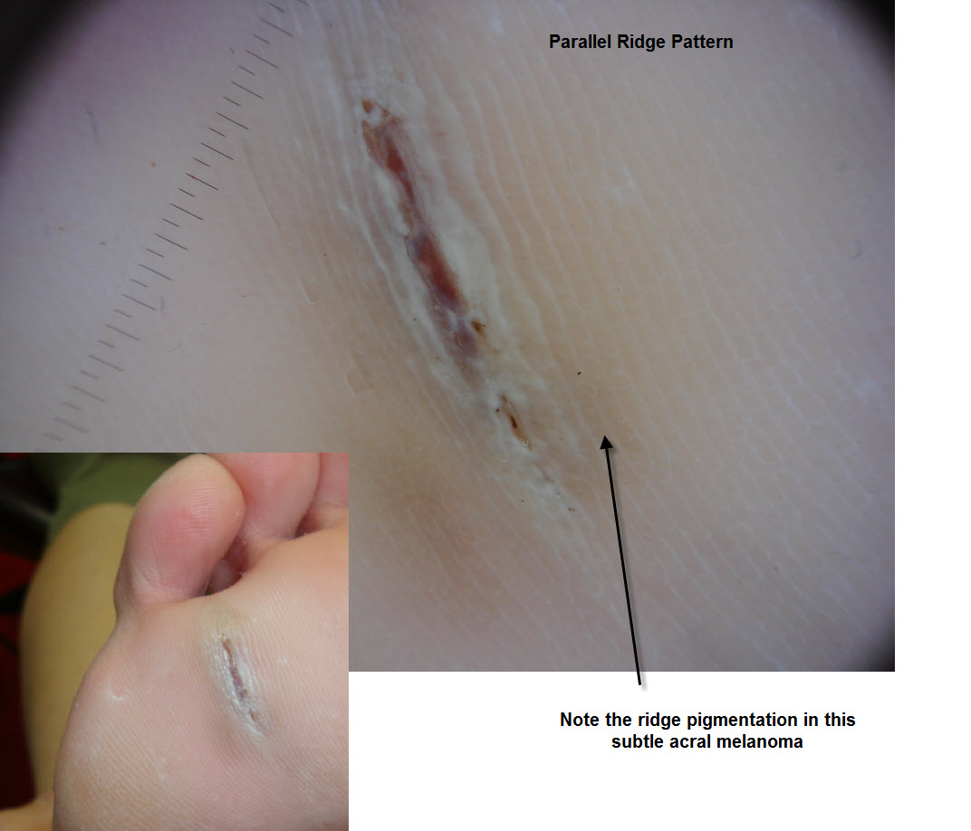 Dermoscopy Made Simple: Lines