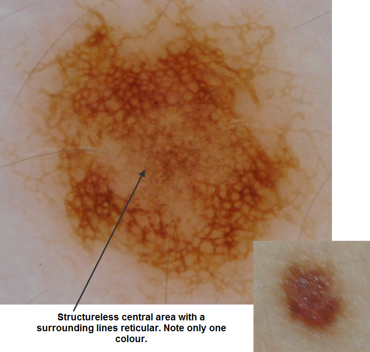 Dermoscopy Made Simple: Clark or Dysplastic nevi