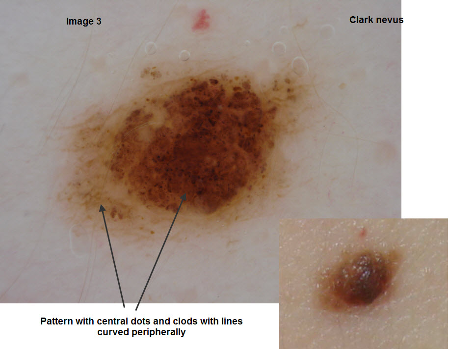 Dermoscopy Made Simple: Clark or Dysplastic nevi
