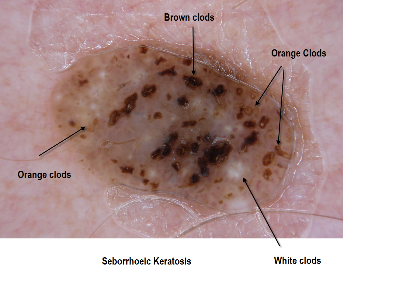 Dermoscopy Made Simple: Colours in Dermoscopy