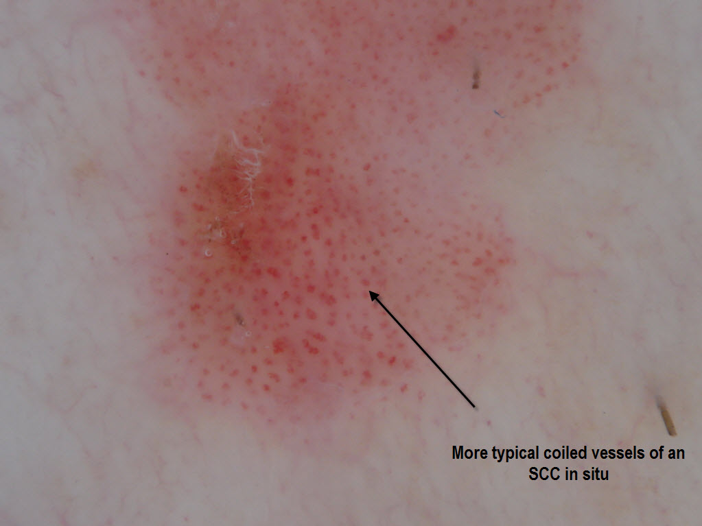 Dermoscopy Made Simple: SCC in Situ and Pigmented Bowen's