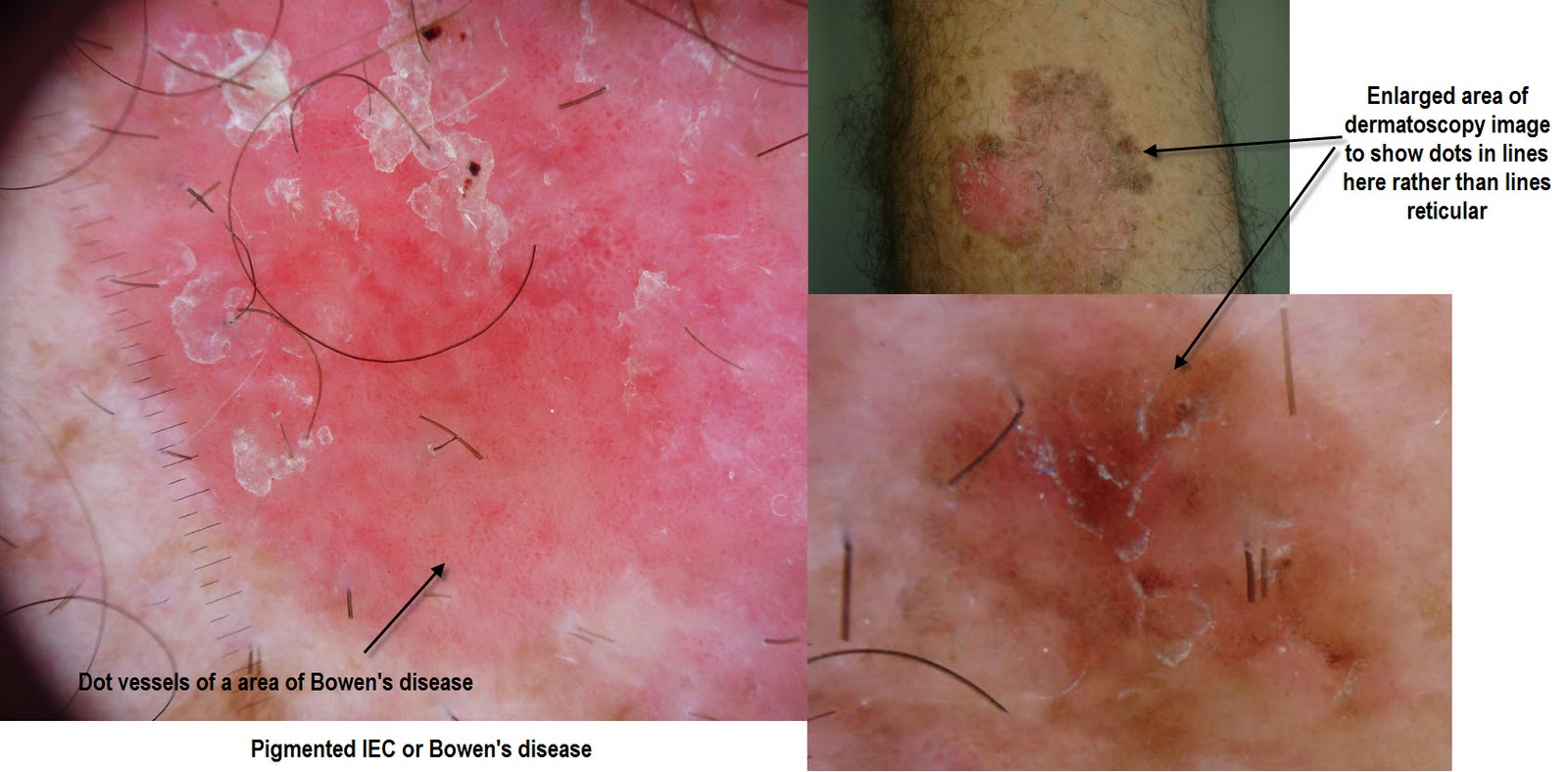 Dermoscopy Made Simple: SCC in Situ and Pigmented Bowen's