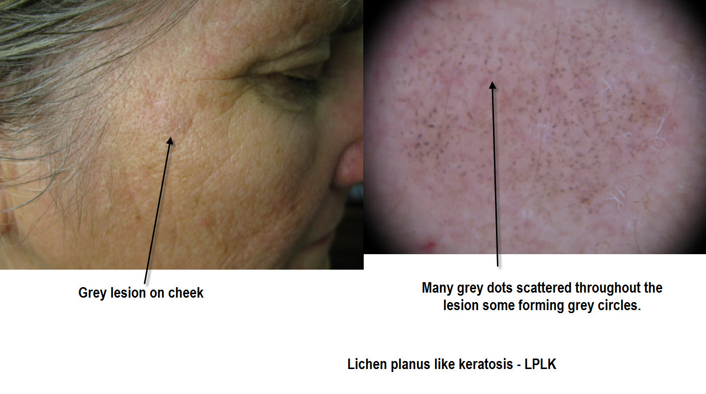 Dermoscopy Made Simple: LPLK