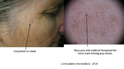 Dermoscopy Made Simple: LPLK