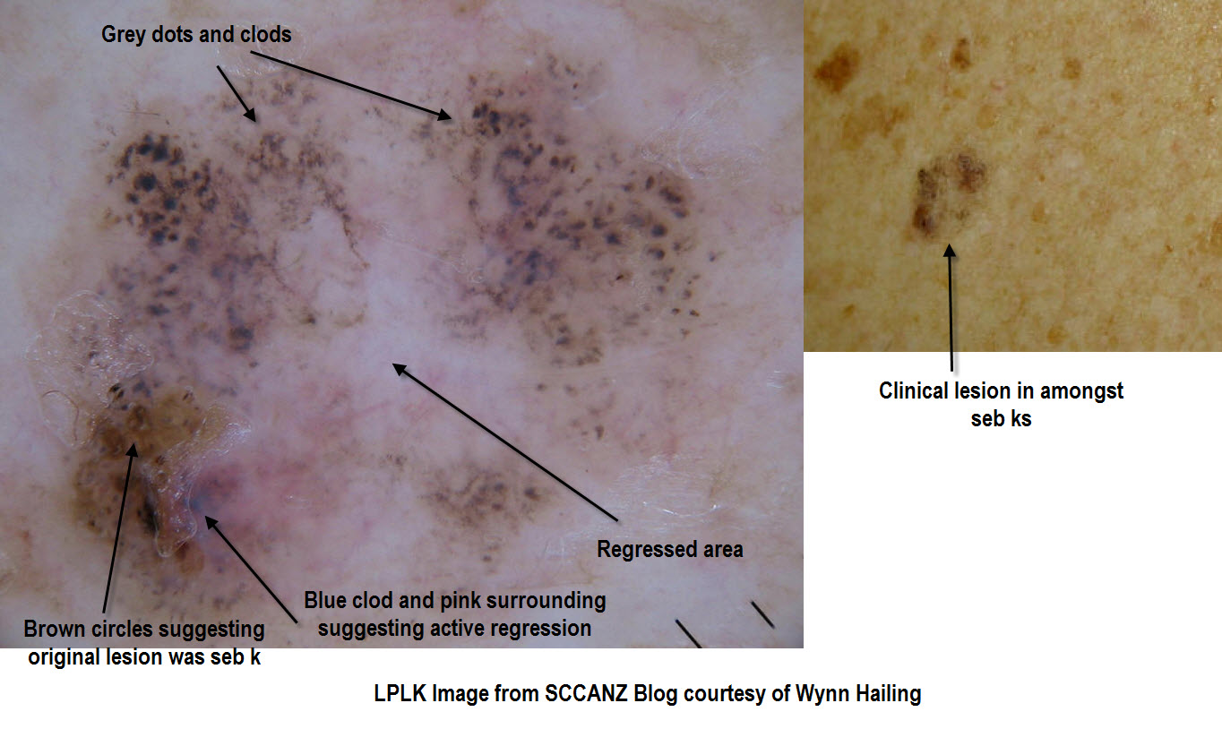 Dermatoscopy Made Simple: LPLK