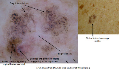 Dermoscopy Made Simple: LPLK