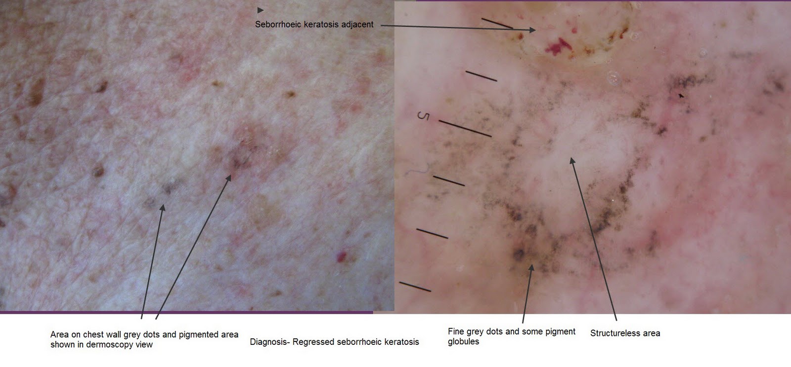 Dermoscopy Made Simple: LPLK