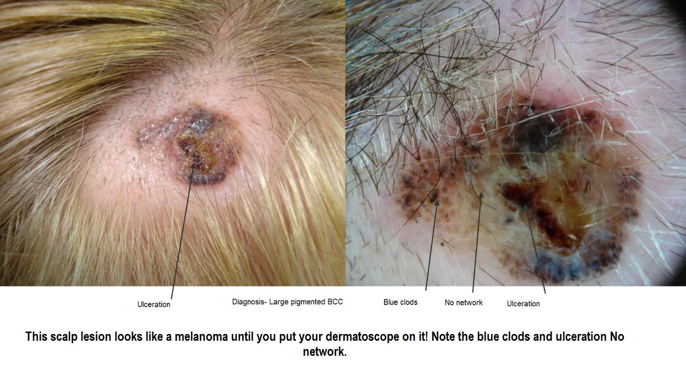Dermoscopy Made Simple: Pigmented BCC
