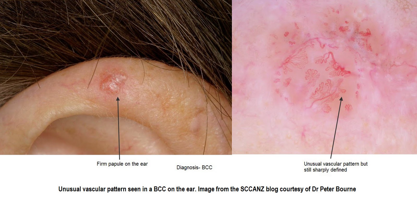 Dermoscopy Made Simple: Basal Cell Carcinoma
