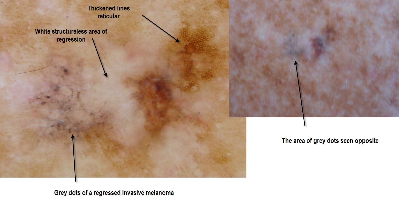 Dermoscopy Features as Clues: Dots Grey