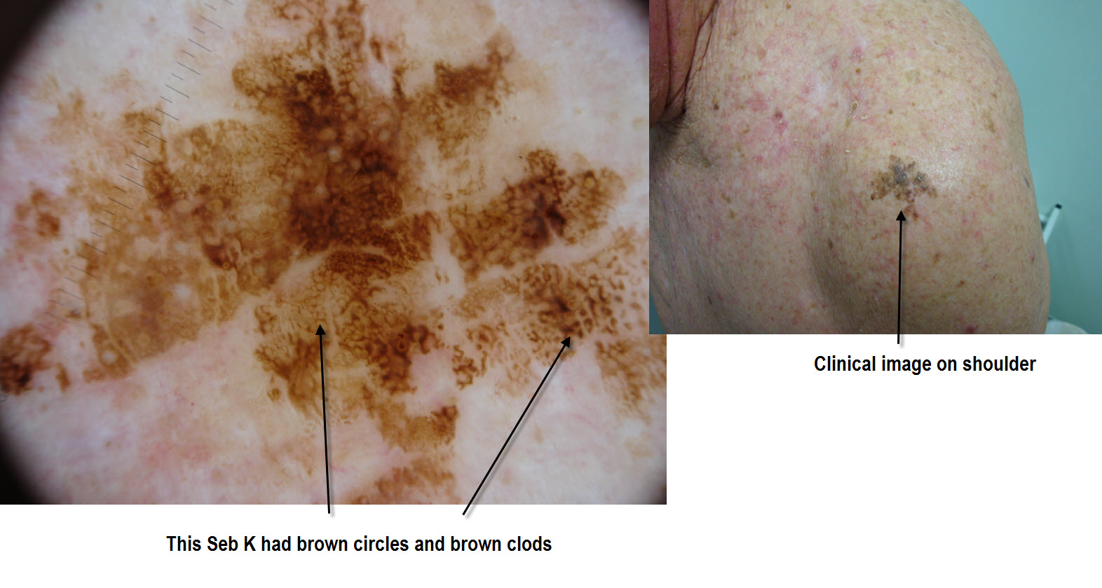 Dermoscopy Made Simple: Seborrhoeic Keratoses