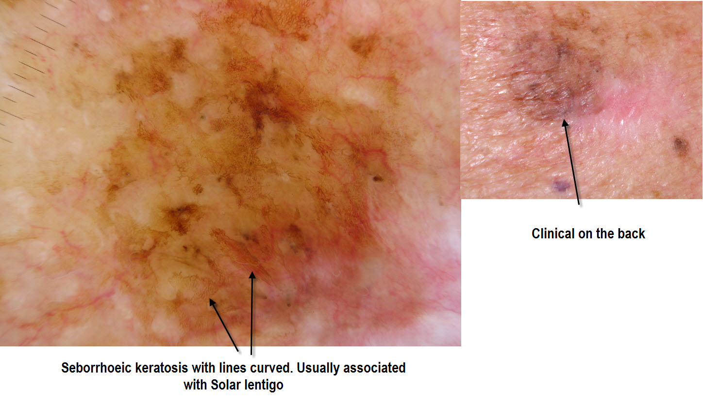 Dermoscopy Made Simple: Seborrhoeic Keratoses