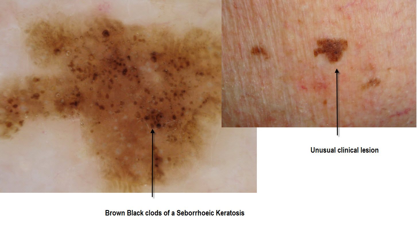 Dermoscopy Made Simple: Seborrhoeic Keratoses