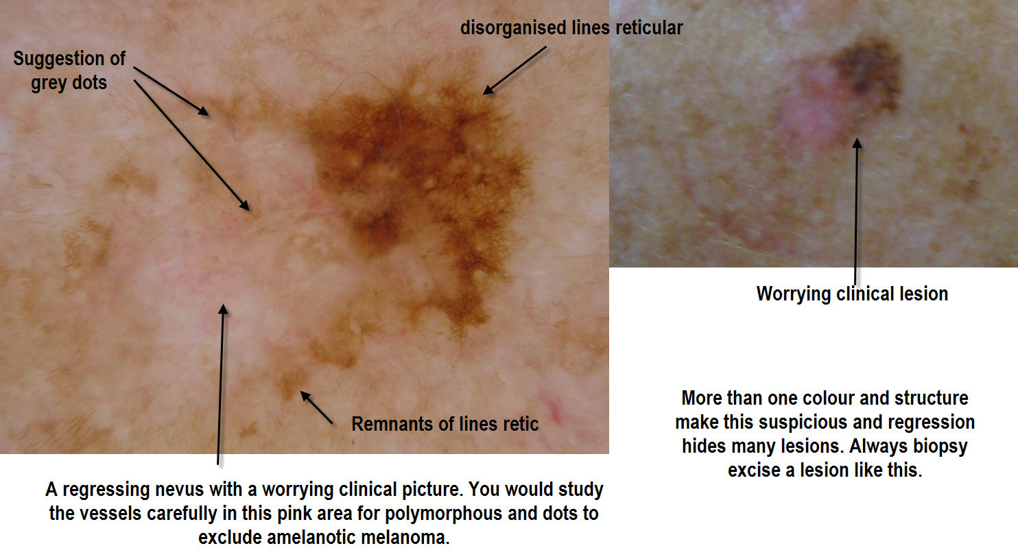 Dermoscopy Made Simple: Benign Nevus