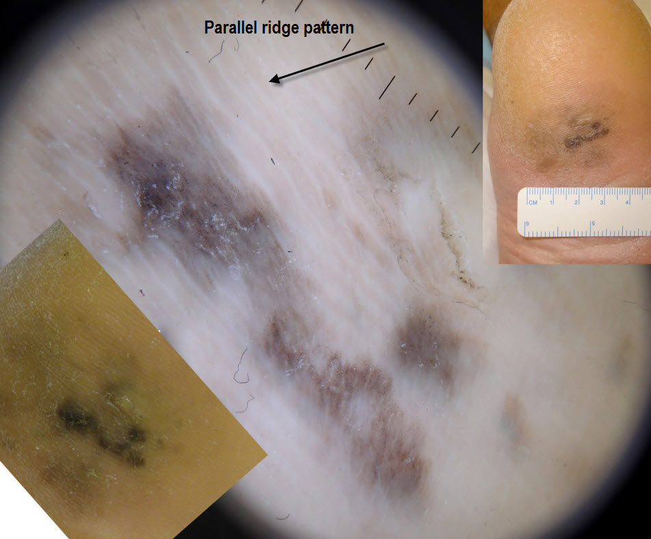 Dermoscopy Made Simple: Acral and Subungual Melanoma