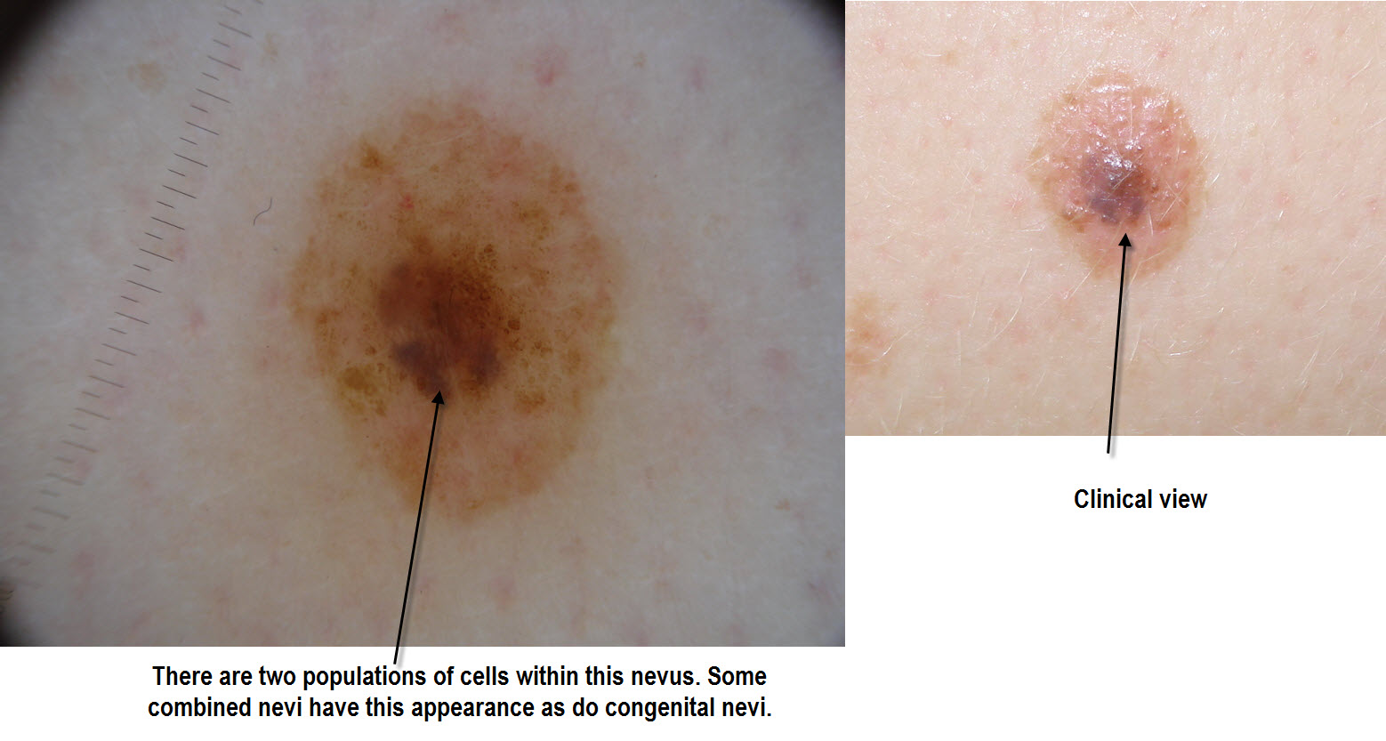 Dermoscopy Made Simple: Benign Nevus