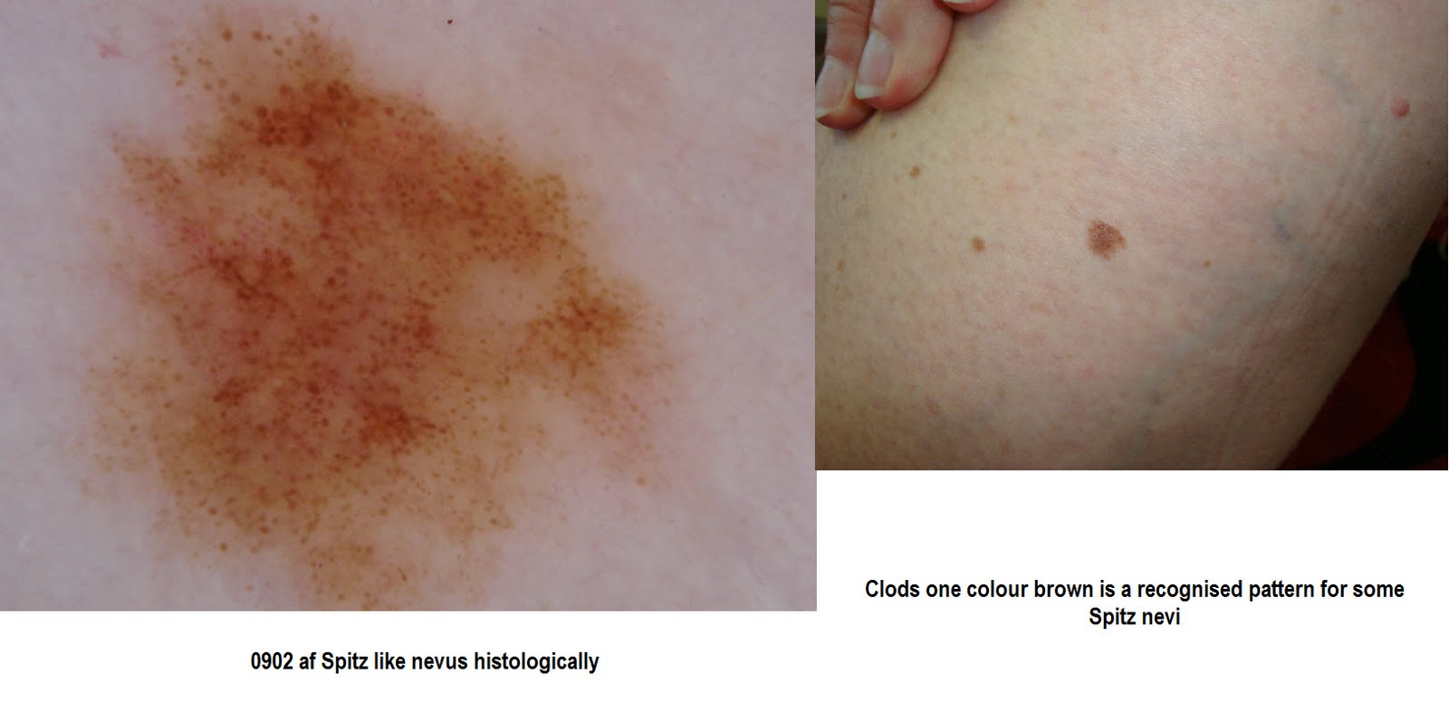 Dermoscopy Made Simple: Spitz Nevus