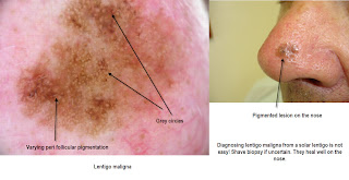 Dermoscopy Made Simple: Lentigo maligna