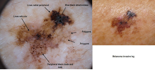 Dermoscopy Features as Clues: Clues to Melanoma