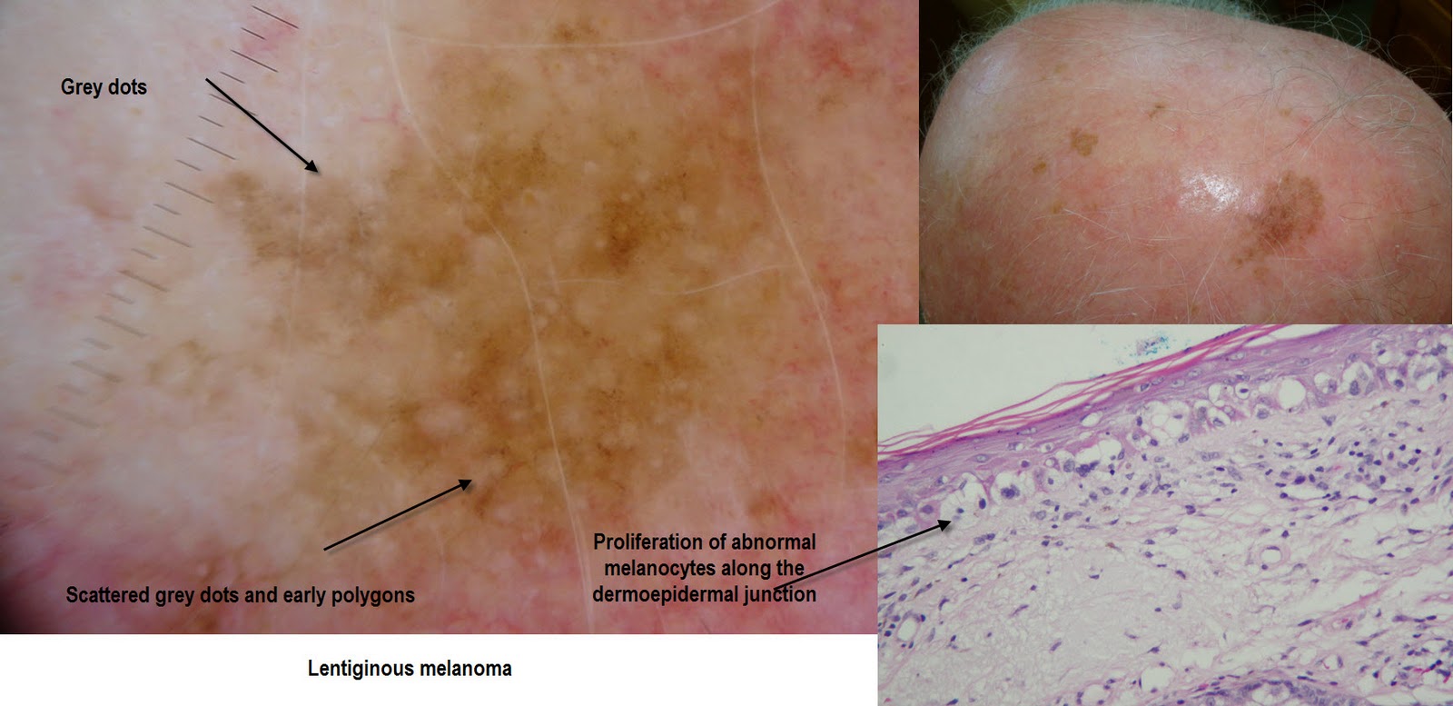 Dermoscopy Made Simple: Melanoma in situ mainly