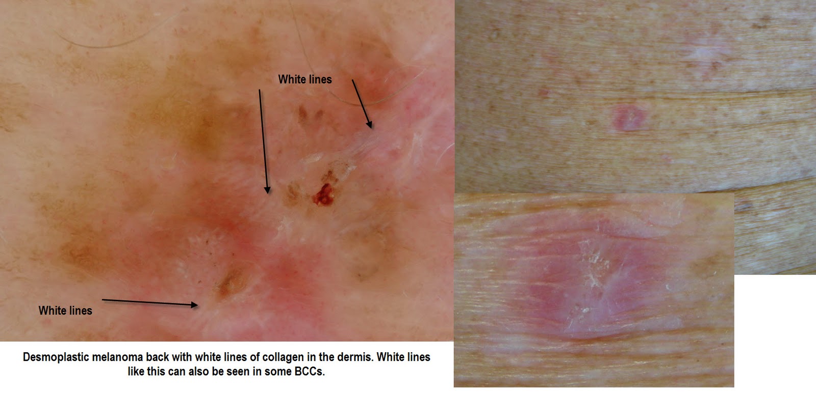 Dermoscopy Features as Clues: Clues to Melanoma