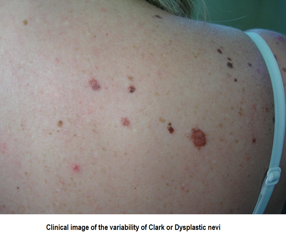 Dermoscopy Made Simple: Clark or Dysplastic nevi