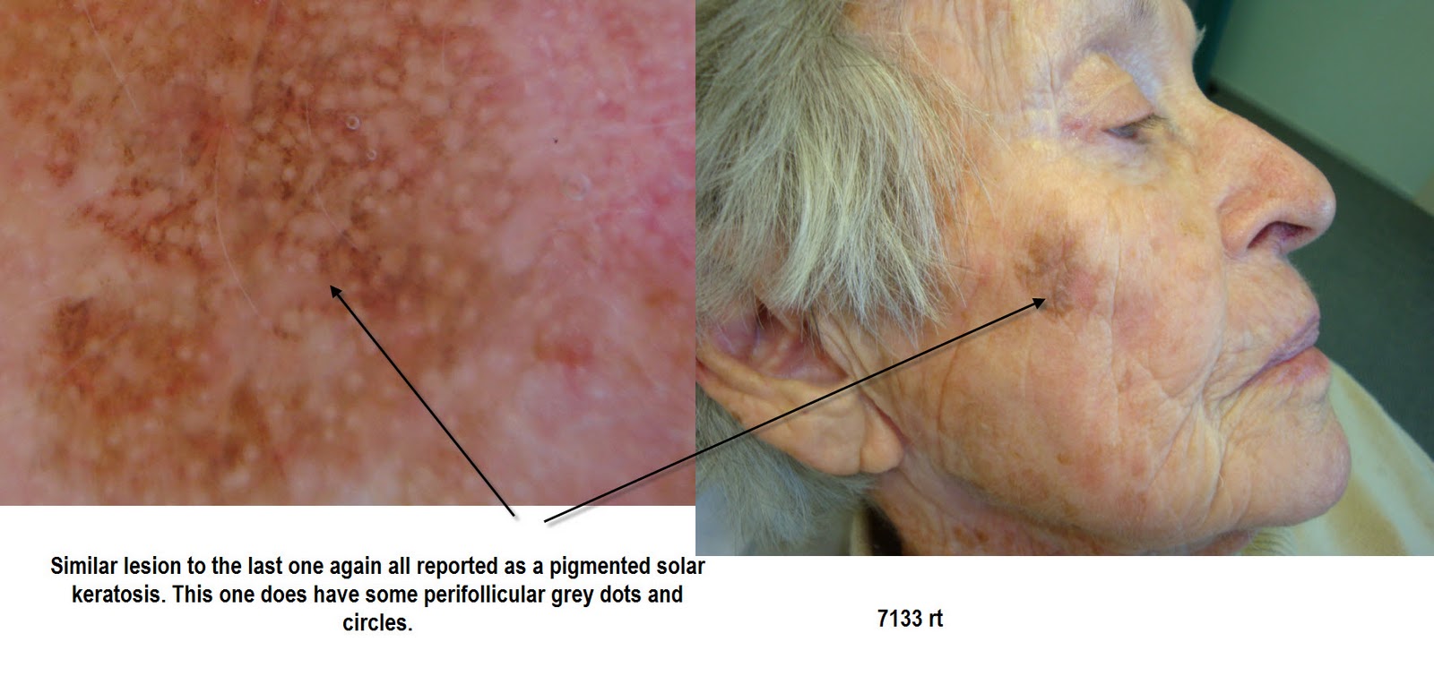 Dermoscopy Made Simple: Solar keratosis
