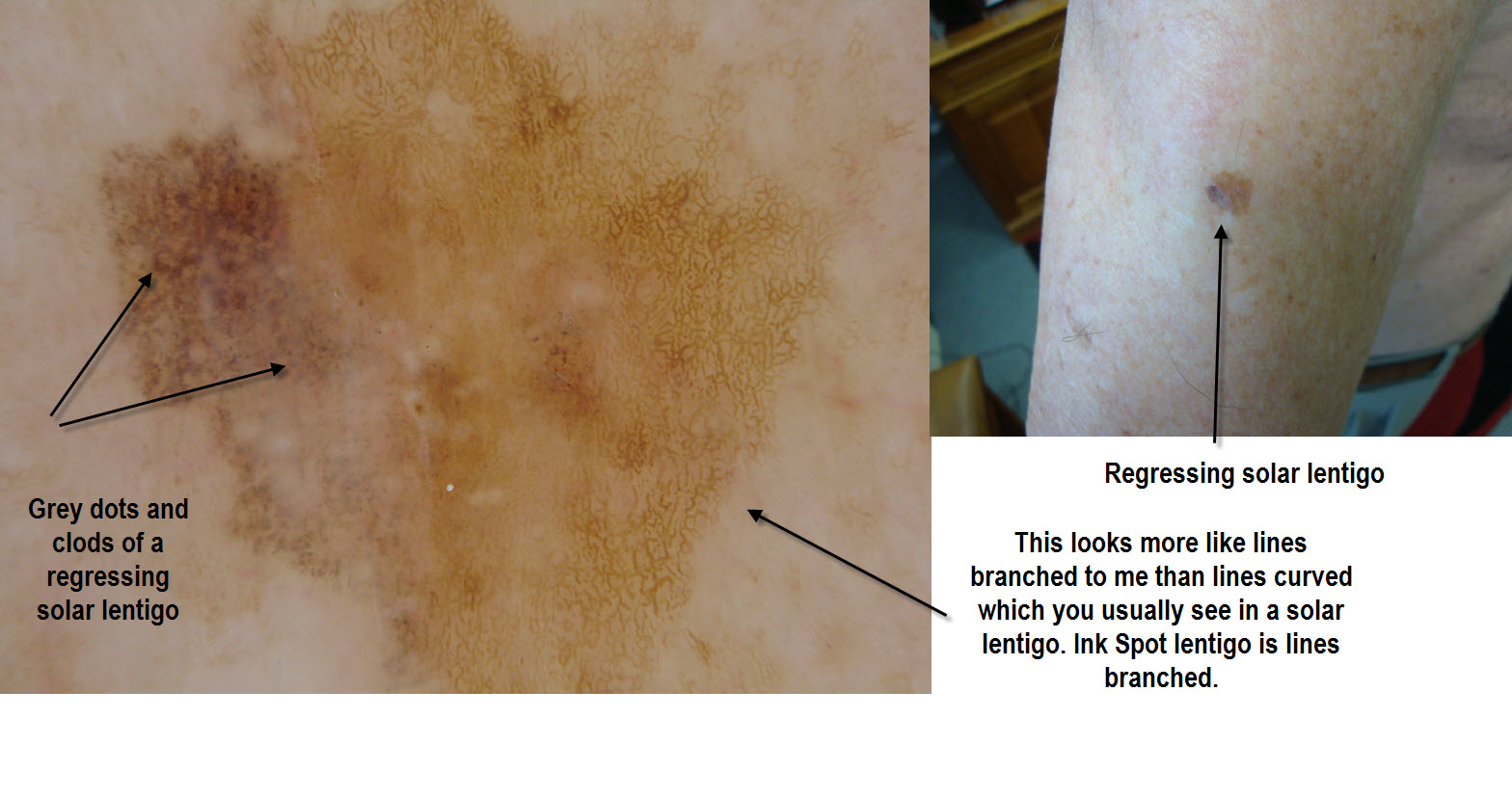 Dermoscopy Made Simple: Solar Lentigo