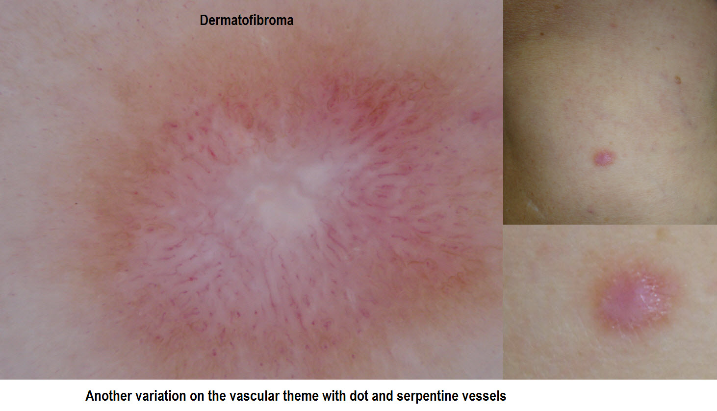 Dermatofibroma Dermoscopy