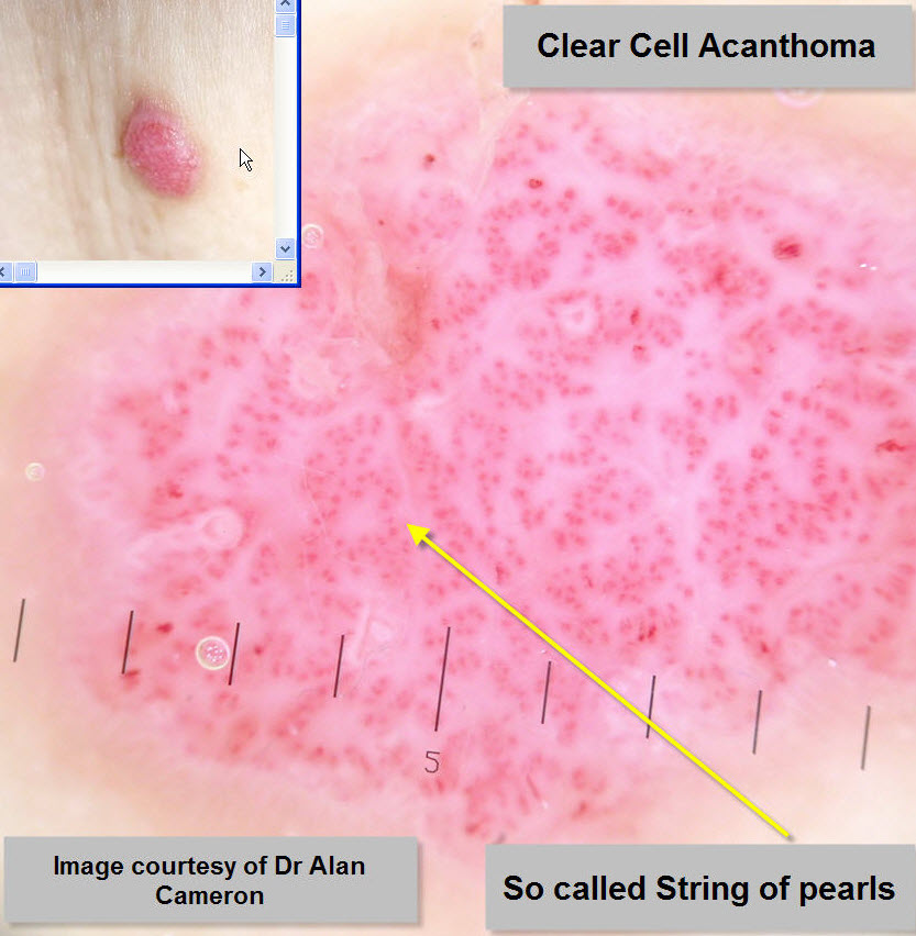 Dermoscopy Made Simple: Clear Cell Acanthoma