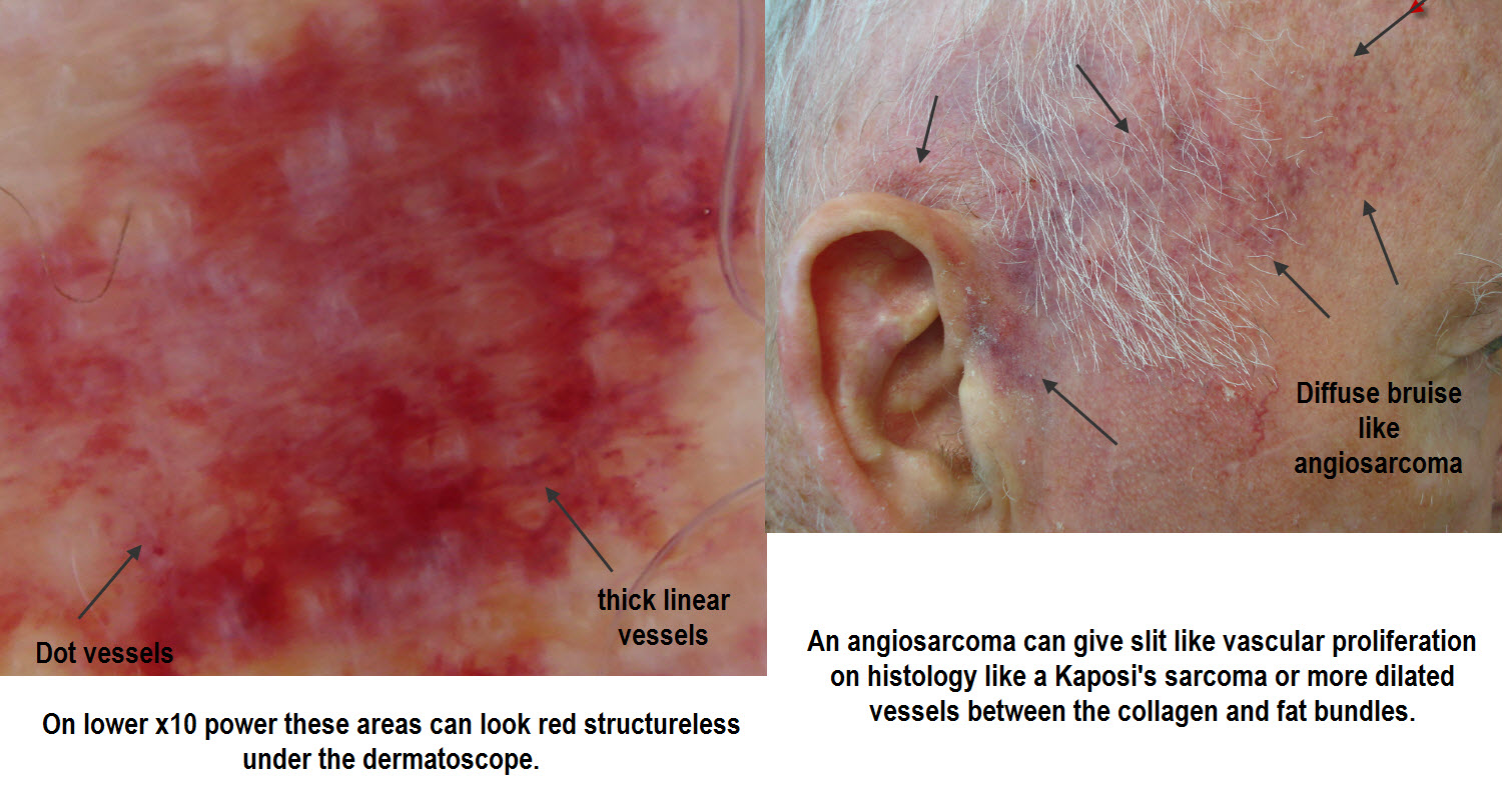 Dermoscopy Made Simple: Rare and Unusual tumours