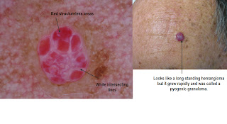 Dermoscopy Made Simple: Haemangioma and Angiokeratoma