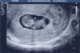 The Creech Twins: 10 weeks 1 day Ultrasound Photos