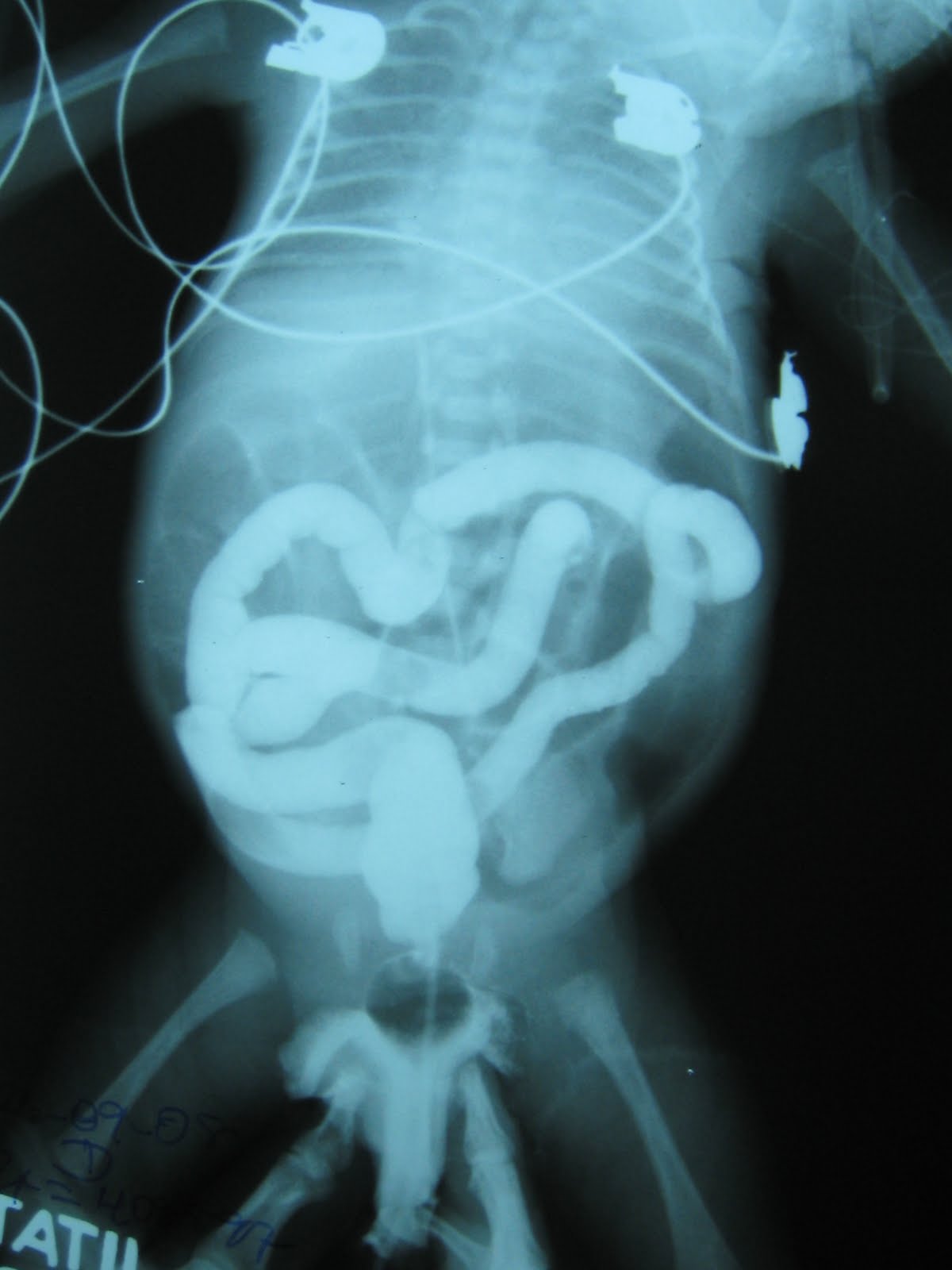 por impactación fecal