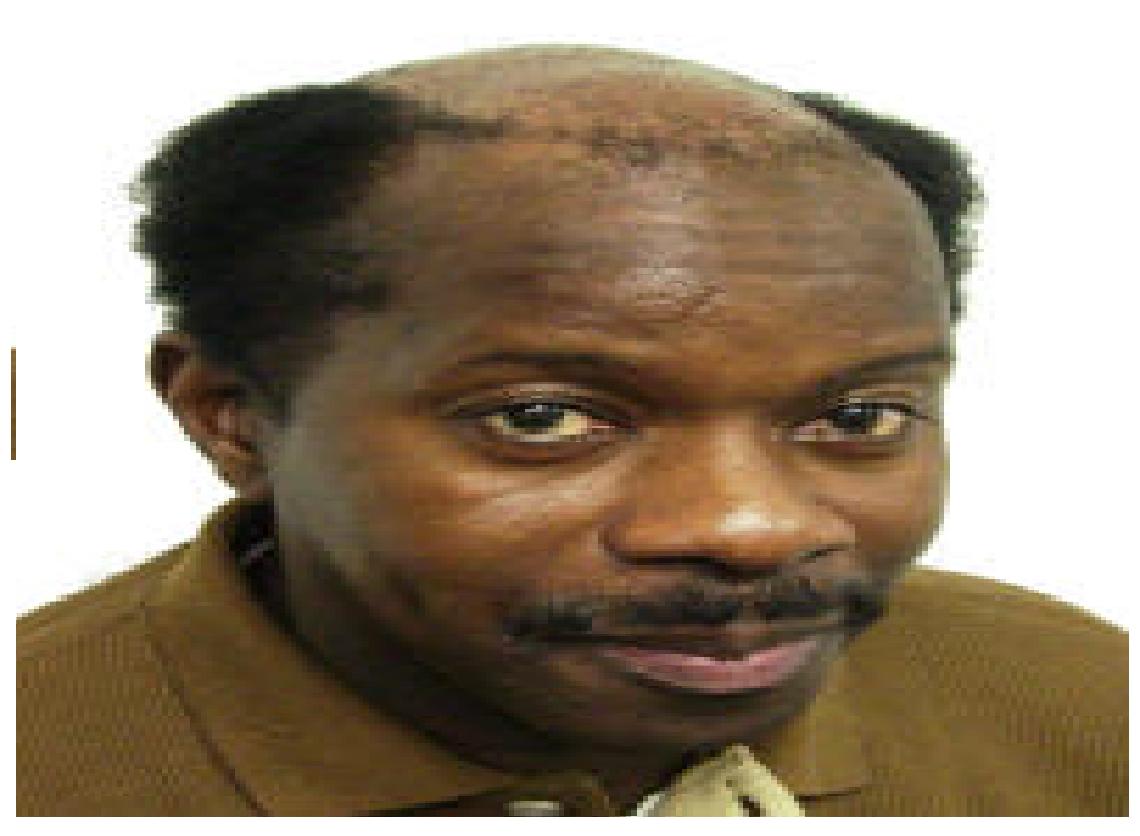 Distribución Productos Farmacéuticos: productos para la calvicie