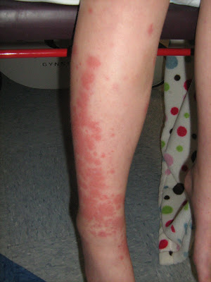Life with the Aytes: Taylor + red rash + leg/ankle swelling - HSP