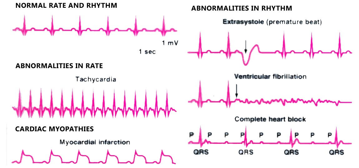 Please Give Some Pictures Of Abnormal ECGs I Want To Compare The Please Give Some Pictures Of Abnormal ECGs I Want To Compare The