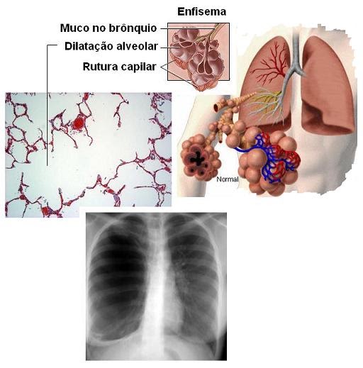 Fisio na Patologia: ENFISEMA PULMONAR