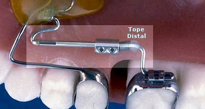 Ortodoncia callao: Distalizacion de Caninos