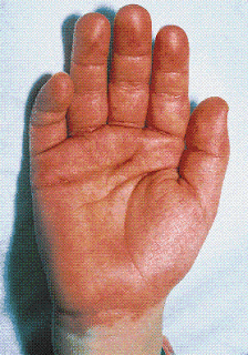 medico isss ped: FIEBRE ESCARLATINA