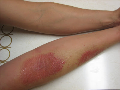 Severe Reactions to ... Make that Poison Oak...