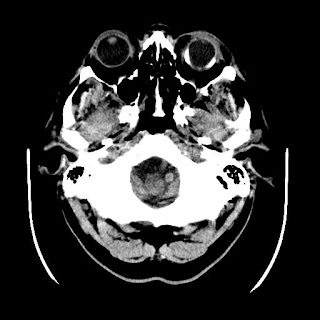 RiT radiology: What is this ocular prosthesis called?