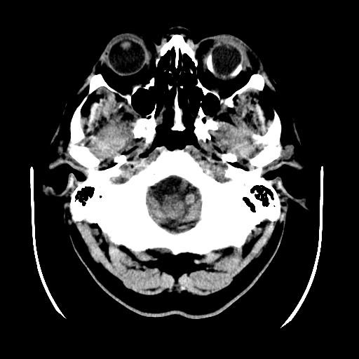 RiT radiology: What is this ocular prosthesis called?