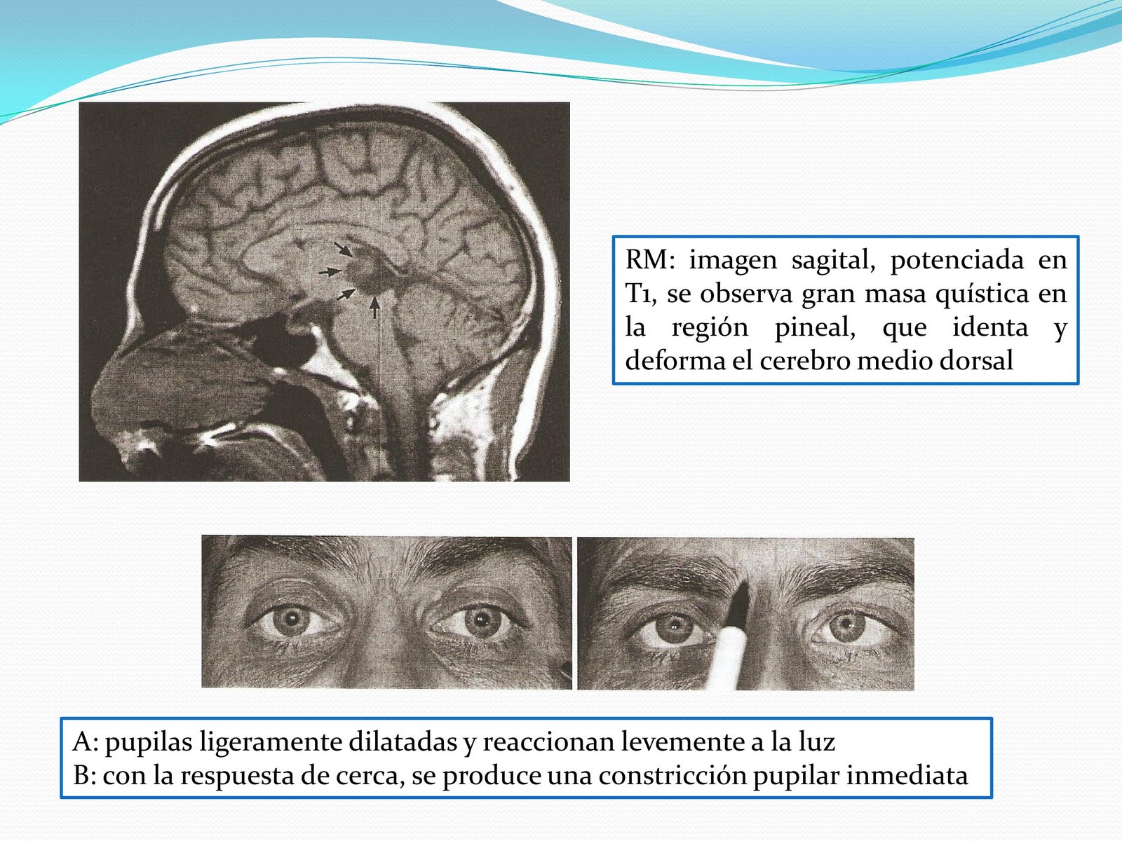 TM Oftalmología: Sistema Supranuclear