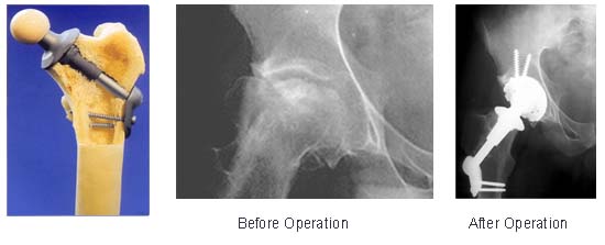 Joint Replacement Surgery in India: Hip Joint Replacement Surgery and ...