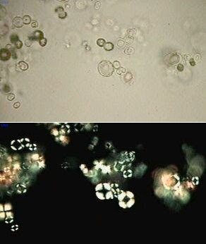 H Panji Irawan: Urinalysis crystals cast